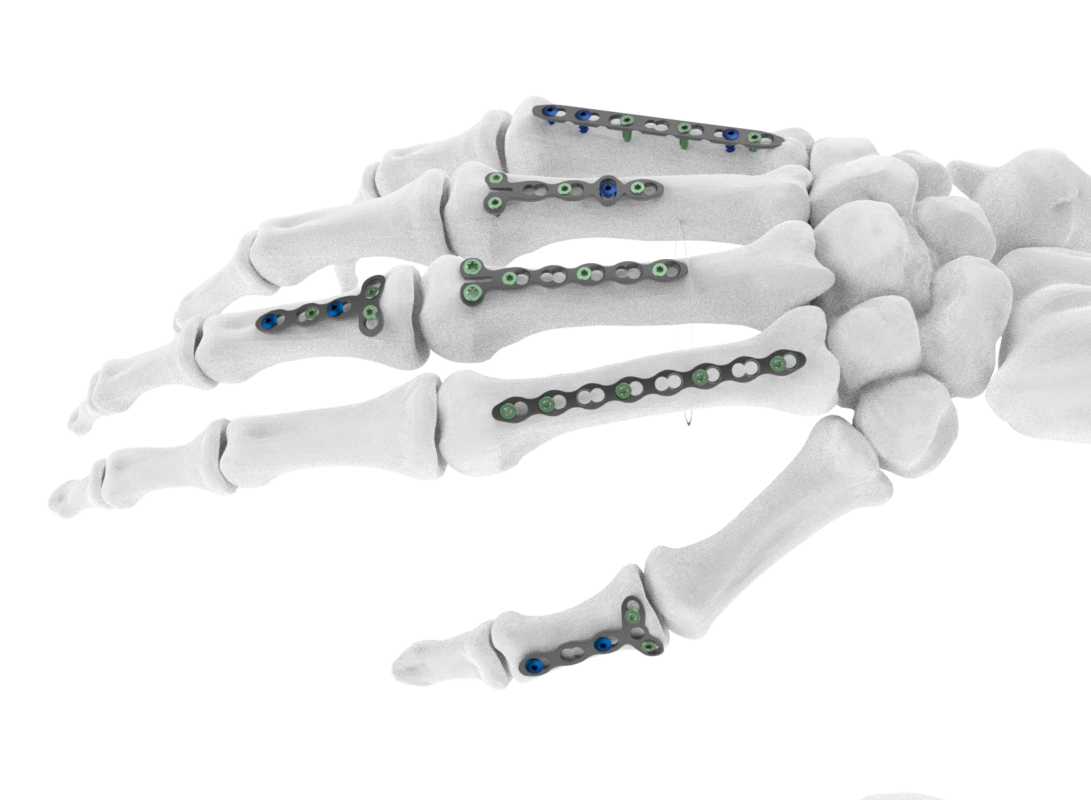 Innovative Solutions for Hand Injuries: The Rise of Locking Plates