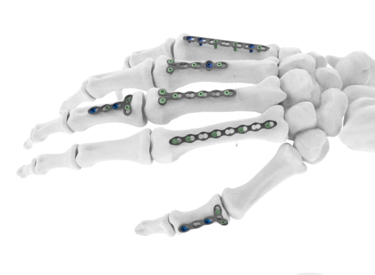 Innovative Solutions for Hand Injuries: The Rise of Locking Plates