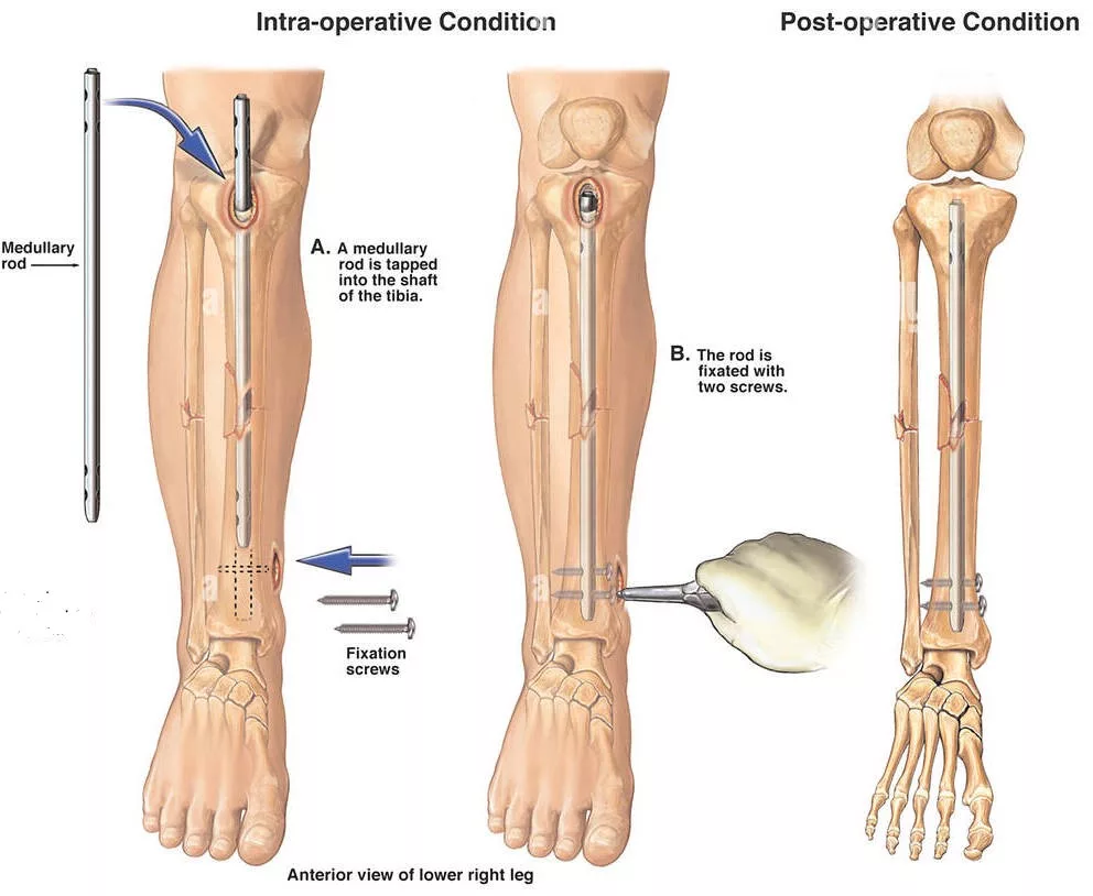 From Diagnosis To Healing An Expert Guide To Tibia Fractures And From Diagnosis To Healing An Expert Guide To Tibia Fractures And