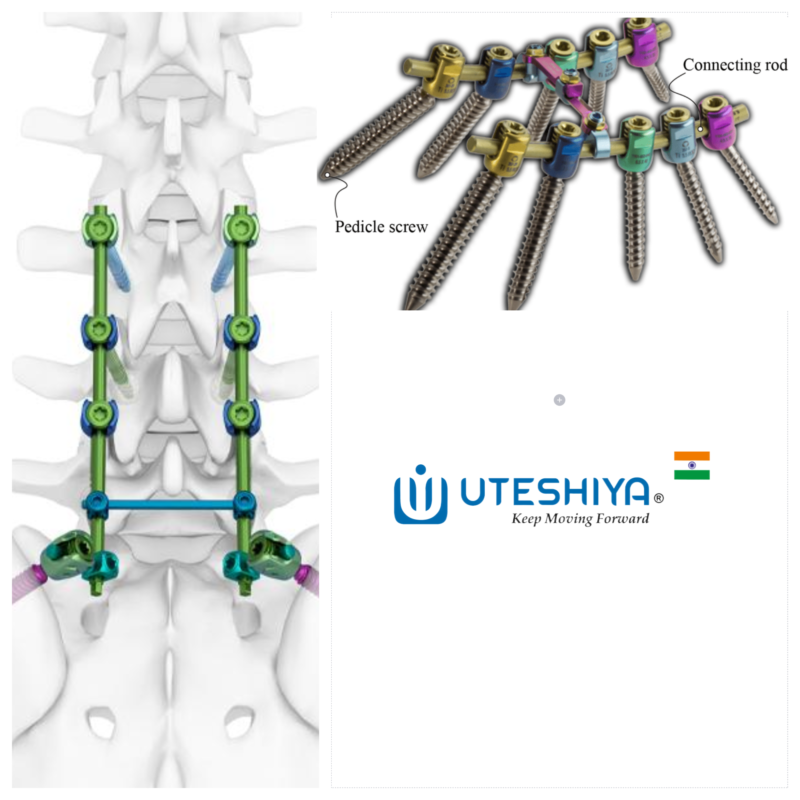 Enhancing Spinal Stability A Comprehensive Guide To Pedicle Screw Systems