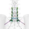 Invisible Strength: The Significance of Connectors in Spinal Surgery ...