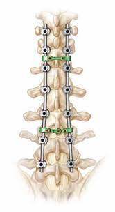 The Crucial Role of Transverse Connectors in Engineering and Beyond ...