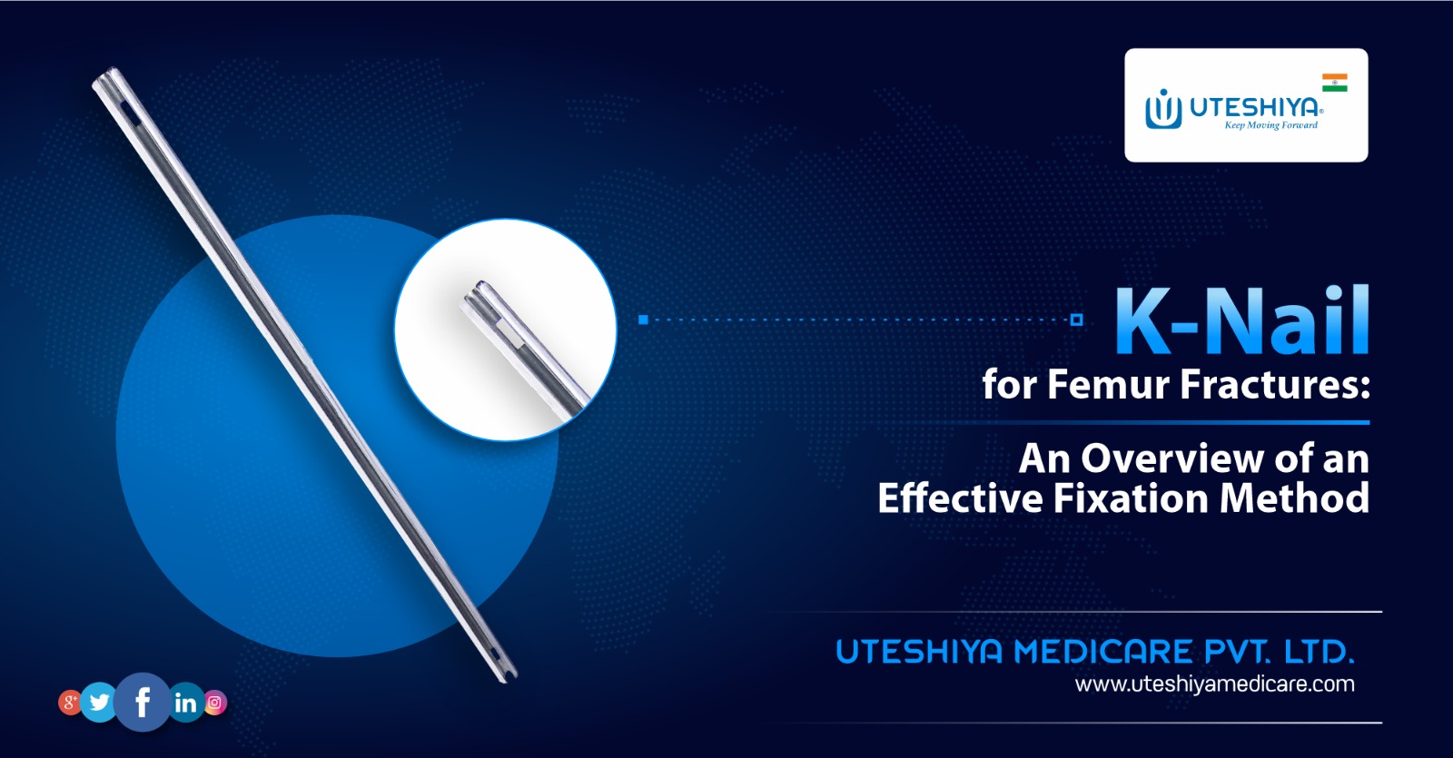 K-Nail for Femur Fractures: An Overview of an Effective Fixation Method ...