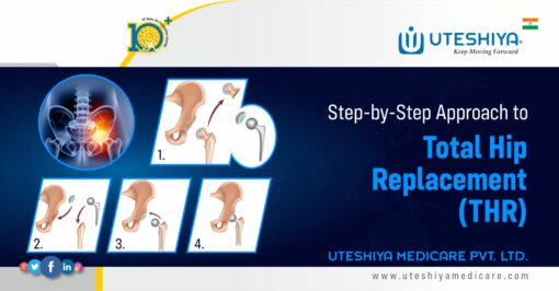 Step-by-Step Approach to Total Hip Replacement (THR) - Orthopedic ...
