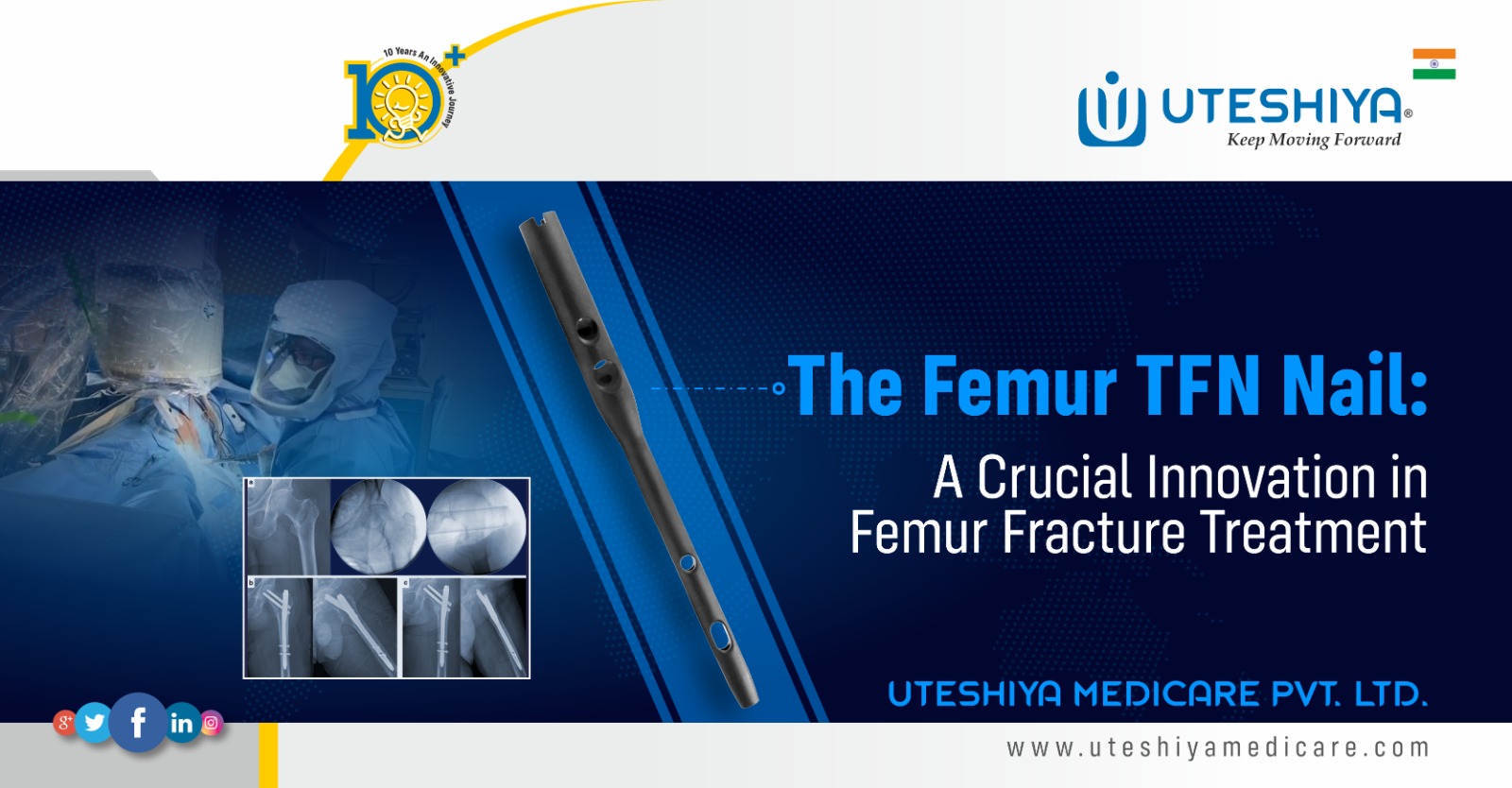 The Femur TFN Nail: A Crucial Innovation in Femur Fracture Treatment ...